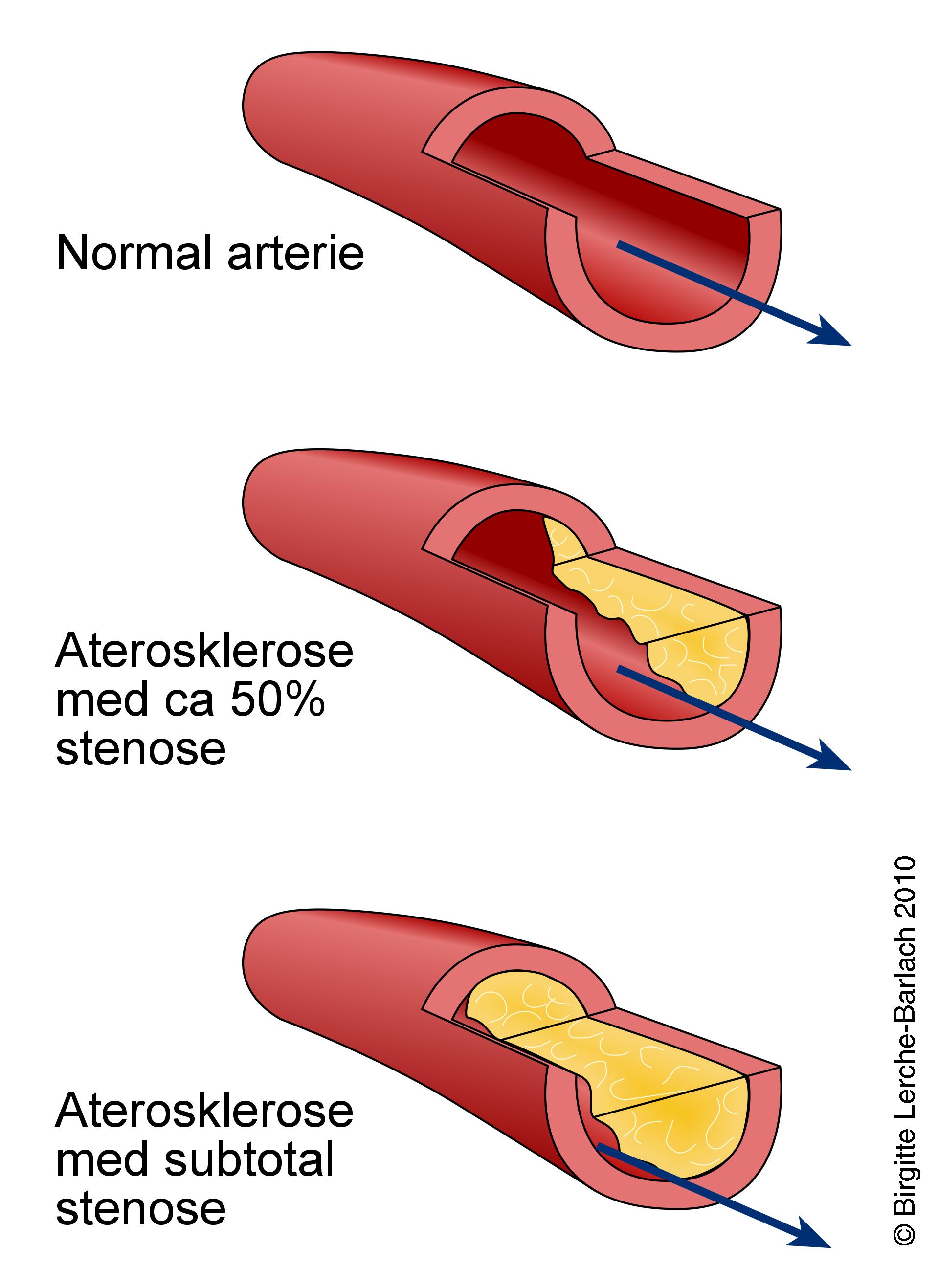 Hypertension - Patienthåndbogen på sundhed.dk