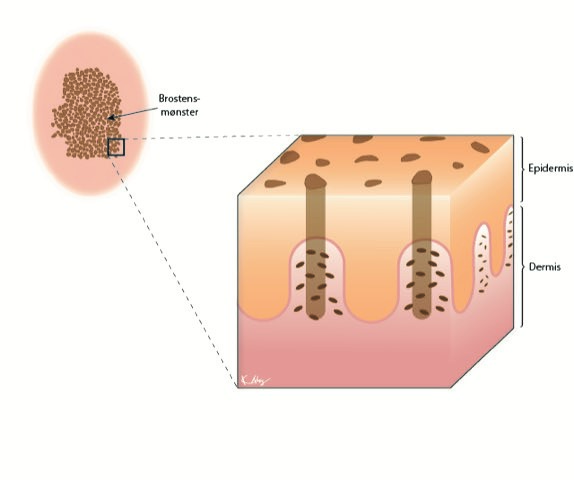 Dermatoskopi - Lægehåndbogen på sundhed.dk
