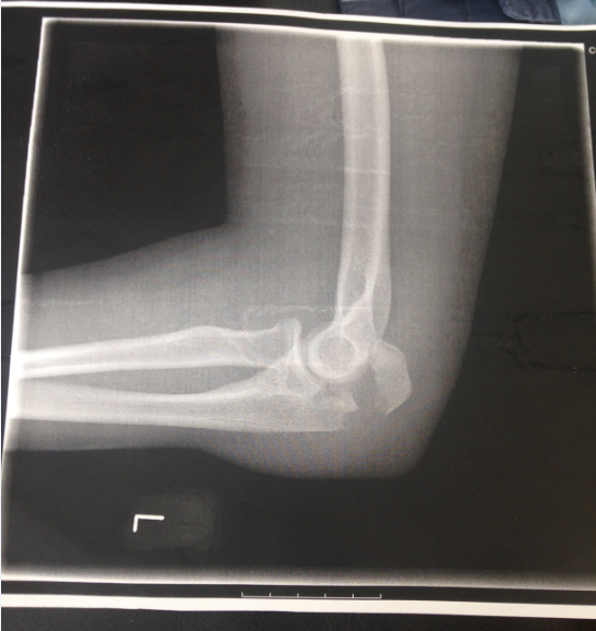 Ulna, olecranonfraktur - Lægehåndbogen på sundhed.dk