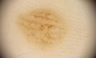 Dermatoskopi - Lægehåndbogen på sundhed.dk