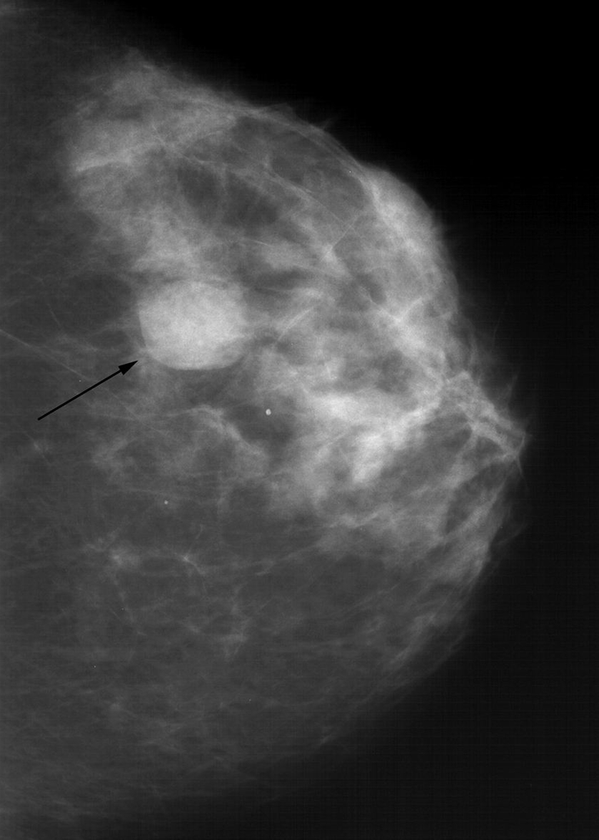Mammografi - Patienthåndbogen på sundhed.dk