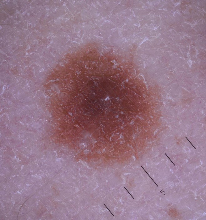 Dermatoskopi - Lægehåndbogen på sundhed.dk