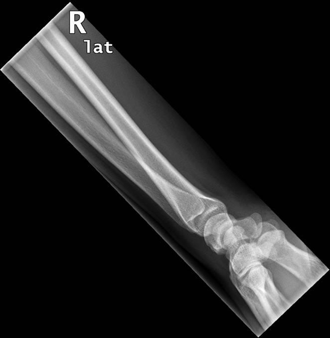 Håndled, Normal, Røntgen - Lægehåndbogen på sundhed.dk