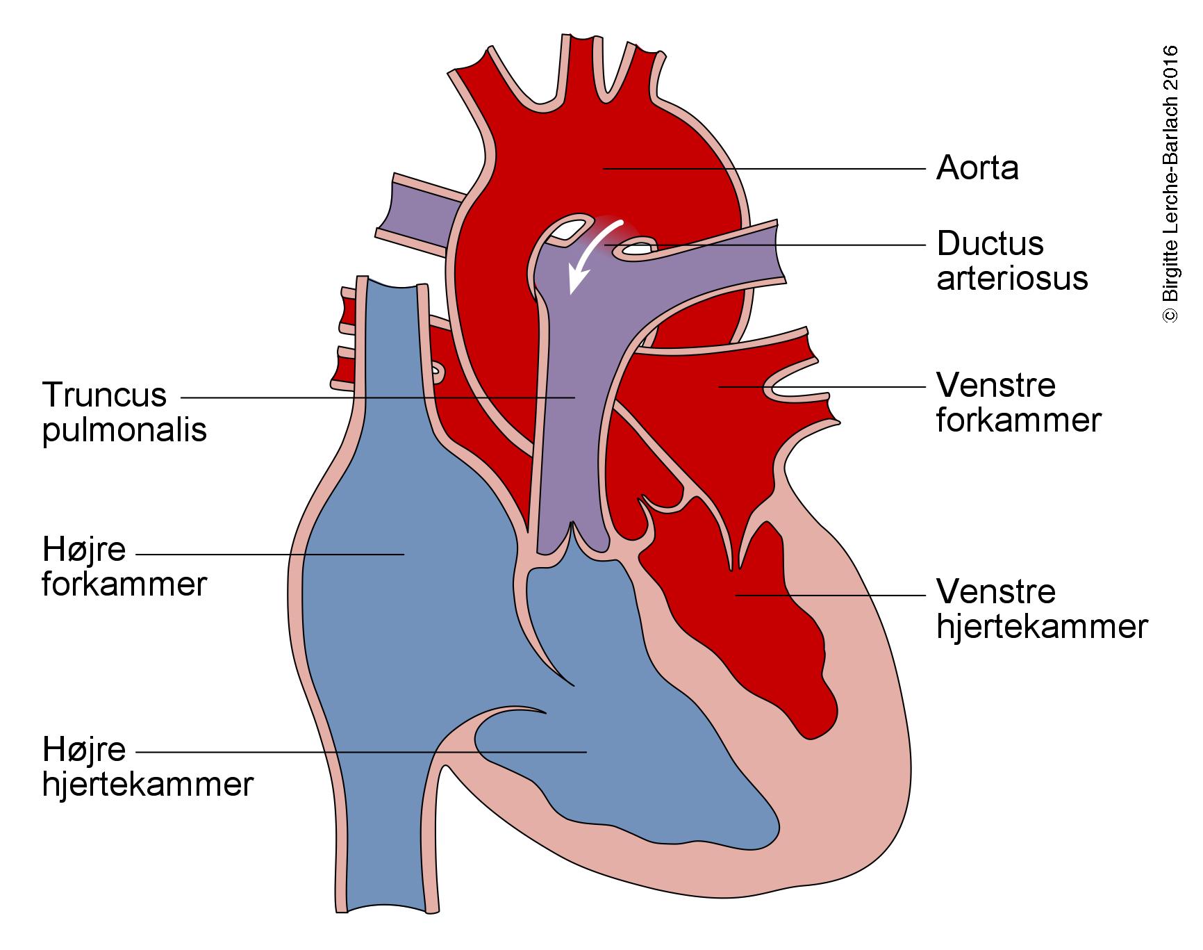 Persisterende ductus arteriosus (PDA) - Patienthåndbogen på sundhed.dk