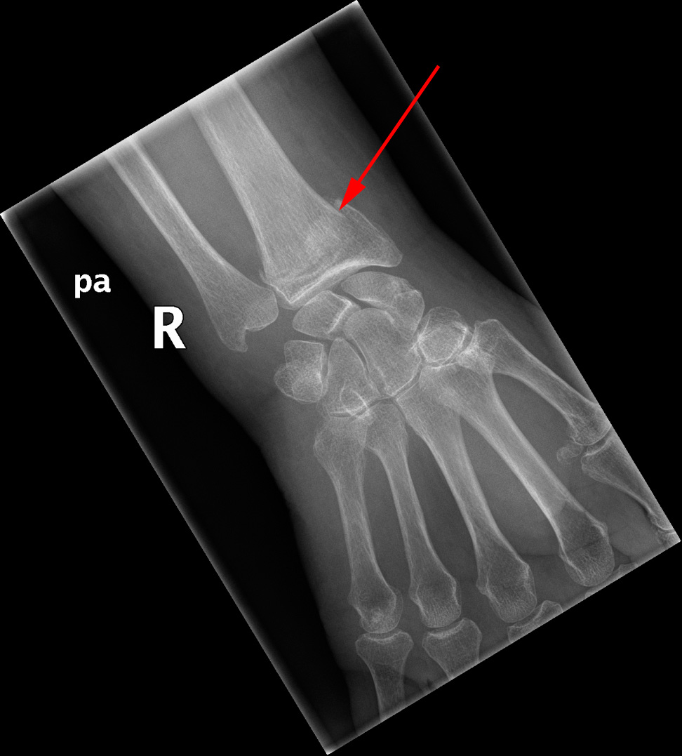 Håndled, Fraktur, Røntgen 1 - Lægehåndbogen på sundhed.dk