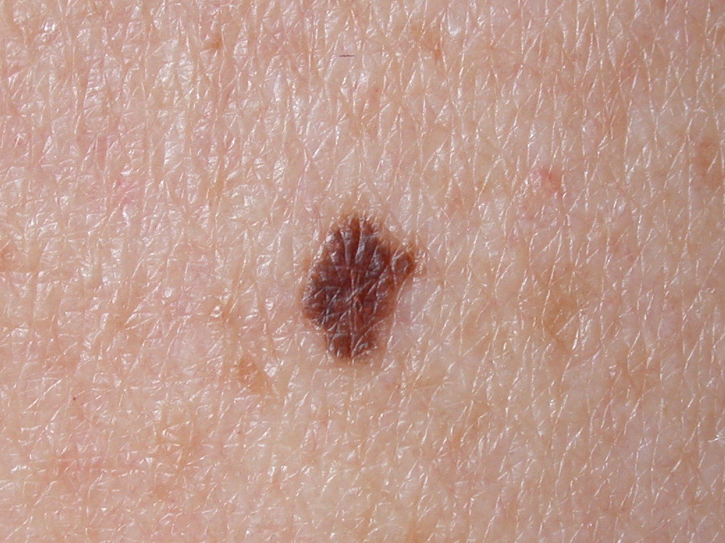 Nævus og andre pigmenterede elementer - Lægehåndbogen på sundhed.dk