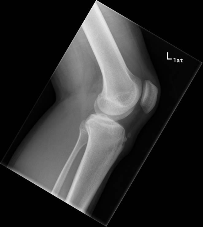 Knæ, Normal, Røntgen - Lægehåndbogen på sundhed.dk