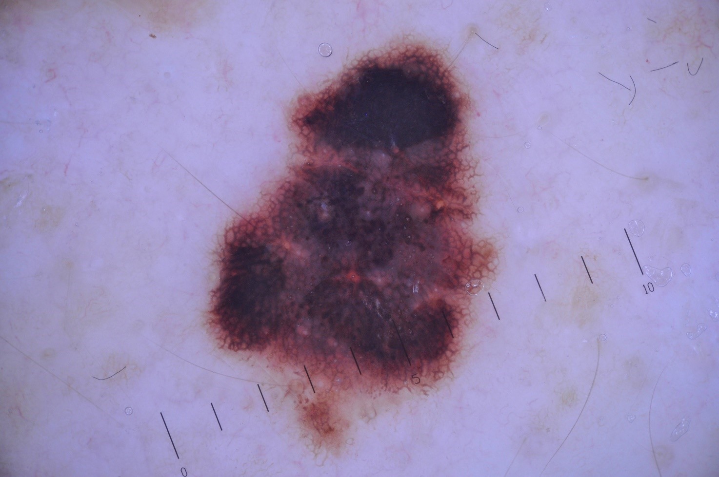 Dermatoskopi - Lægehåndbogen på sundhed.dk