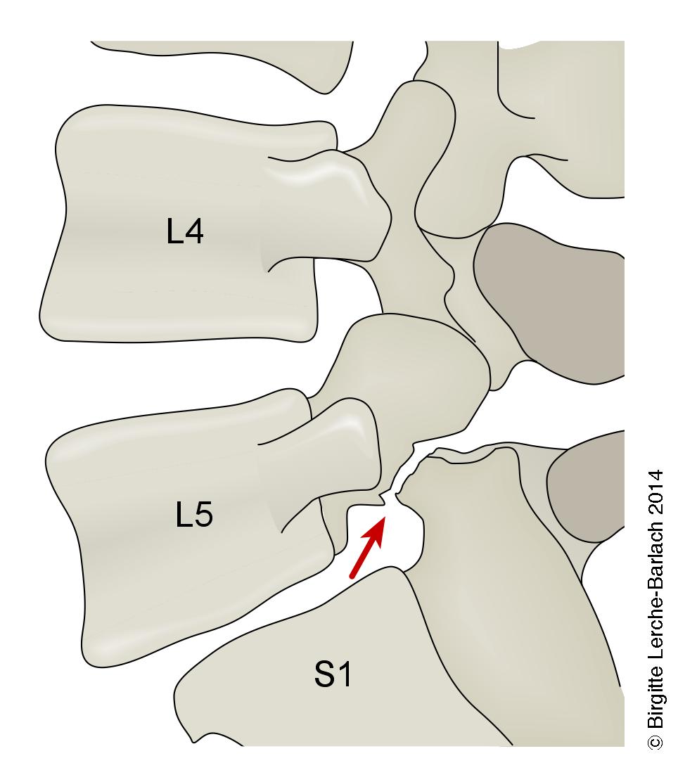 Spondylolyse, spondylolistese, børn - Patienthåndbogen på sundhed.dk